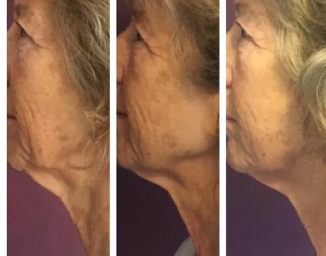 HIFU Treatment | Non-surgical facelift