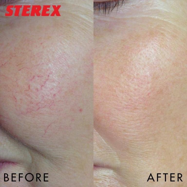 Thread Veins - The Skinologist