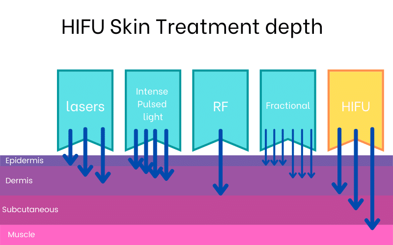 HIFU Treatment | Non-surgical facelift