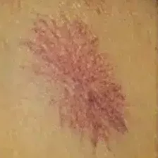 Red Veins and Spider Naevi: learn, common Qs and treatment!