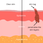 Skin Tags: Learning, Causes, and Treatment to destroy them!
