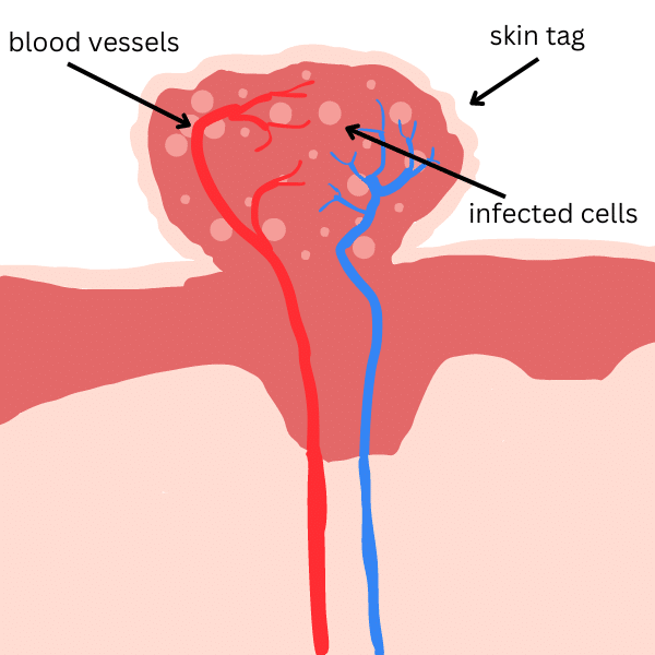 Skin Tags: Learning, Causes, and Treatment to destroy them!